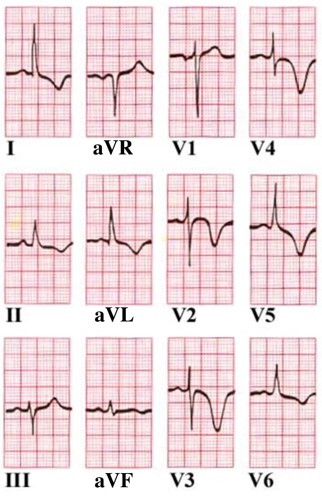 Non-STEMI - Patienthåndbogen på sundhed.dk
