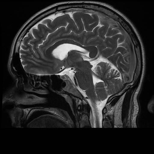 Hjernen Ovenfra Mri