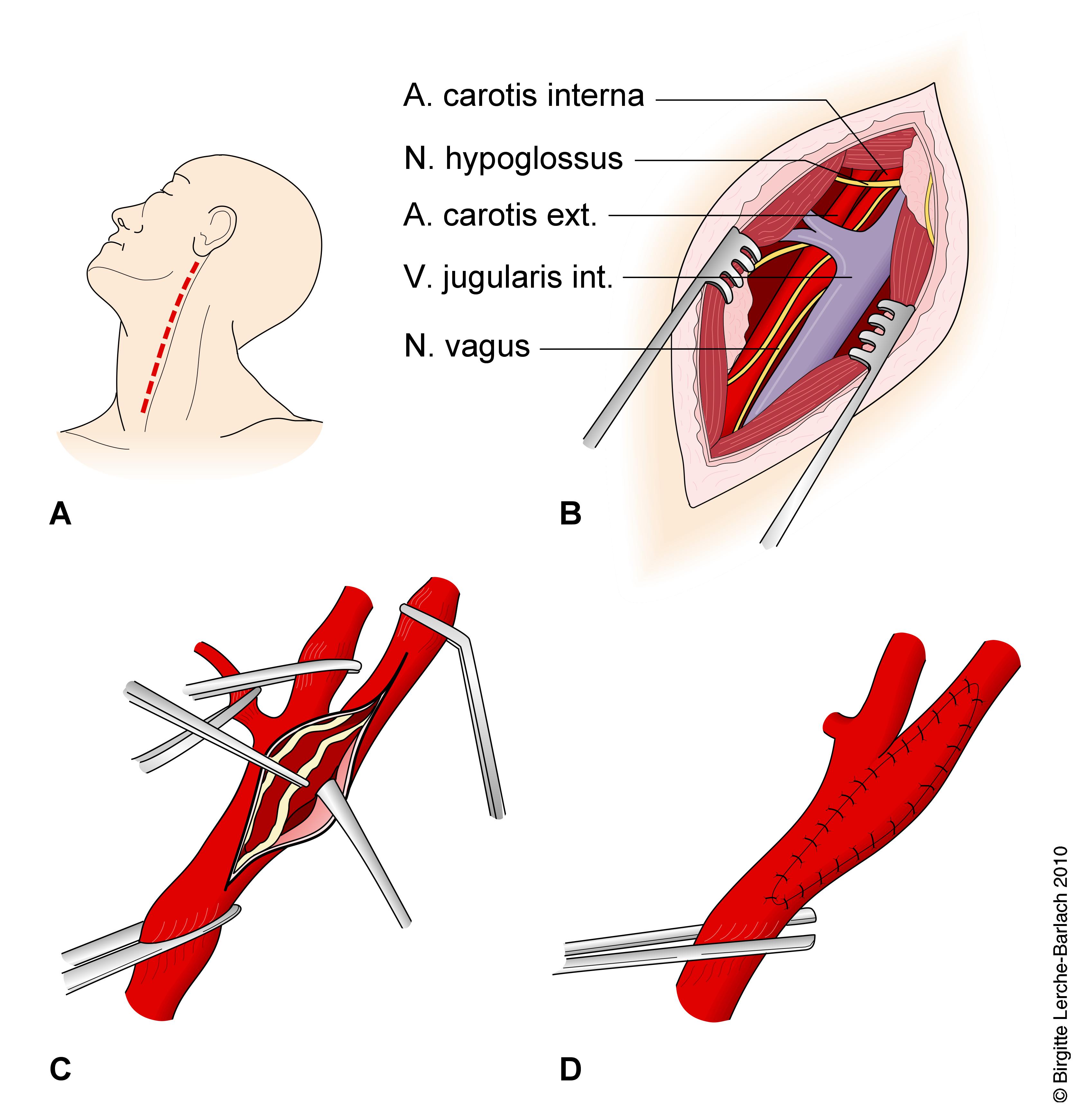 Carotis endarterektomi - Patienthåndbogen på sundhed.dk