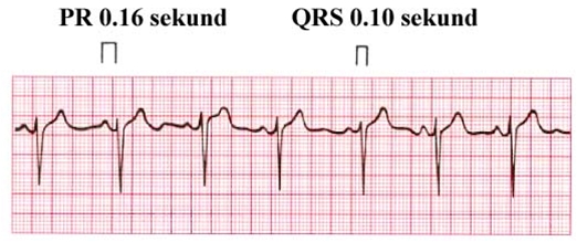 PR- og QRS-interval - Patienthåndbogen på sundhed.dk