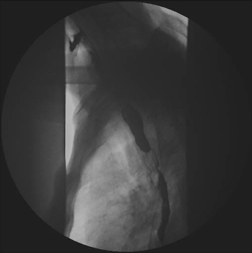 Øsofagus, normal, røntgen - Lægehåndbogen på sundhed.dk