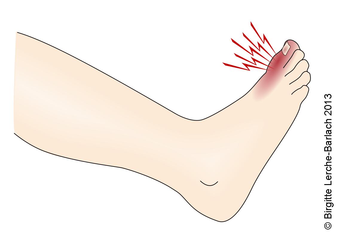 Urinsur gigt, podagra - Patienthåndbogen på sundhed.dk