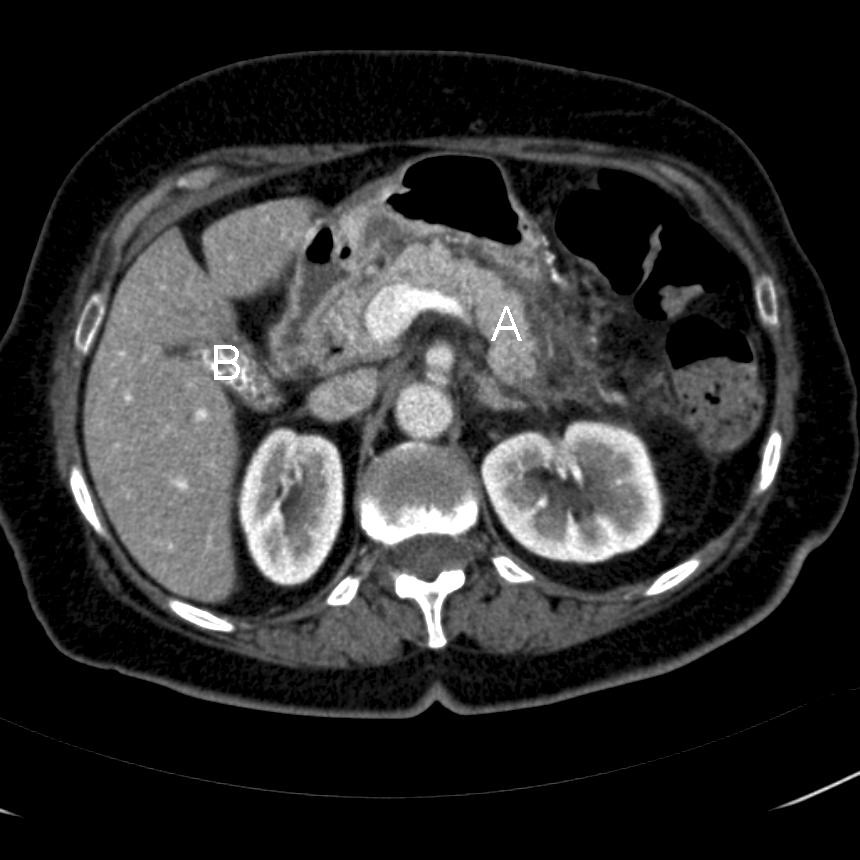 Pankreatit, akut - Lægehåndbogen på sundhed.dk