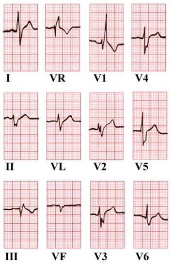 Right bundle branch block (RBBB) - Patienthåndbogen på sundhed.dk