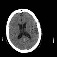 Hjernen, normal, CT - Lægehåndbogen på sundhed.dk