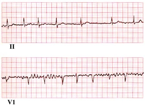 Atrieflimren, EKG - Patienthåndbogen på sundhed.dk