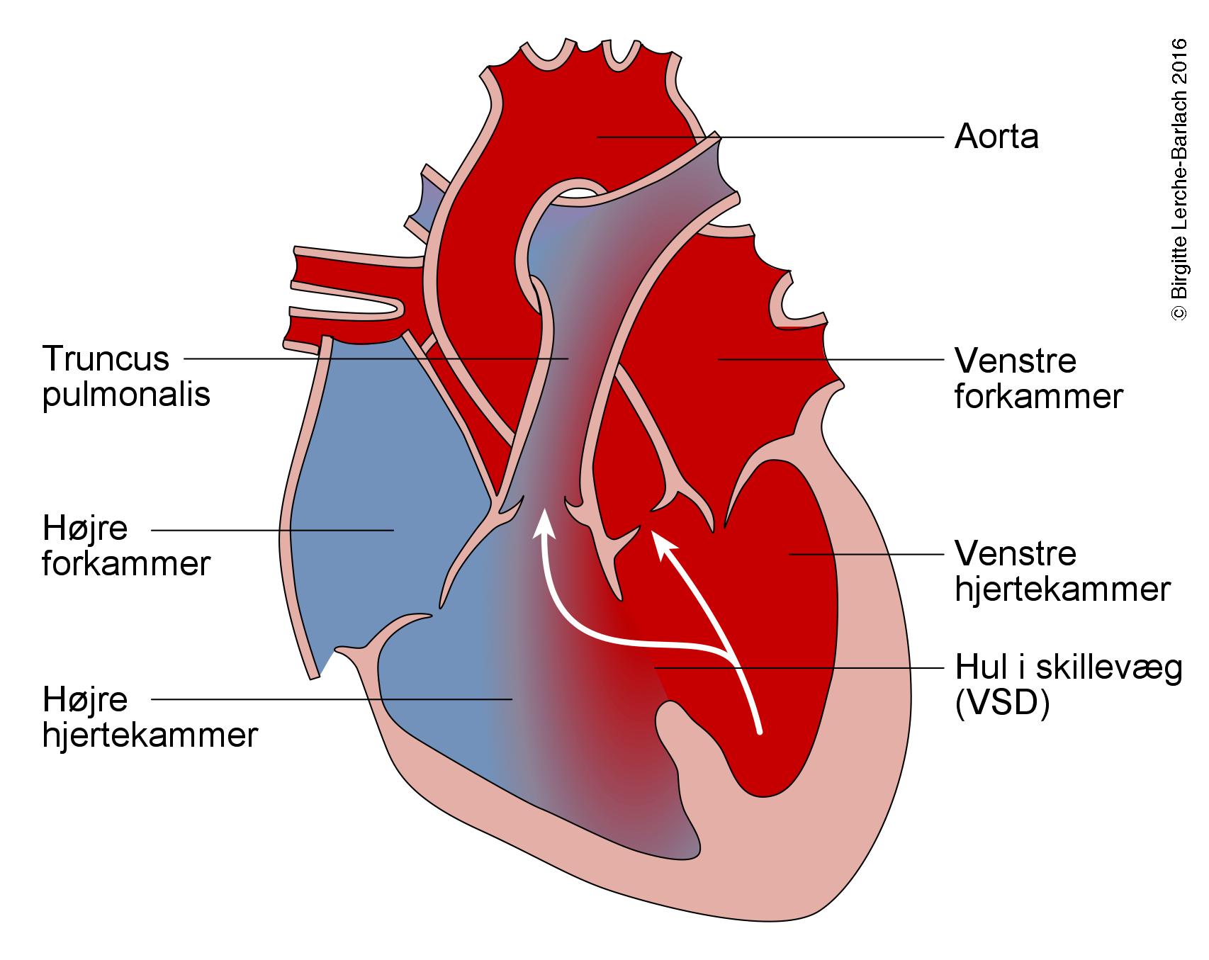 Ventrikelseptumdefekt - Patienthåndbogen på sundhed.dk