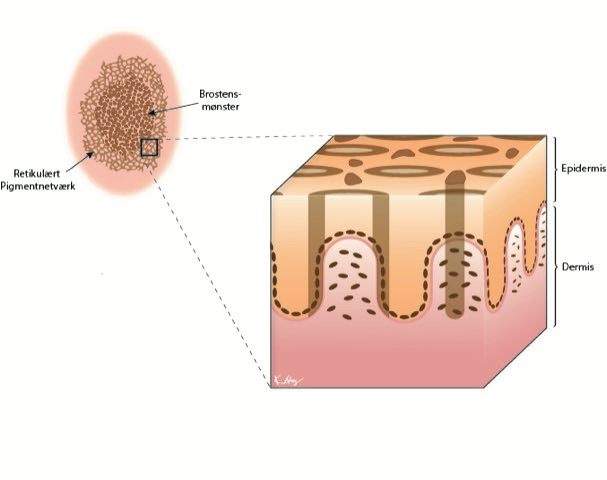 Dermatoskopi - compound - Lægehåndbogen på sundhed.dk