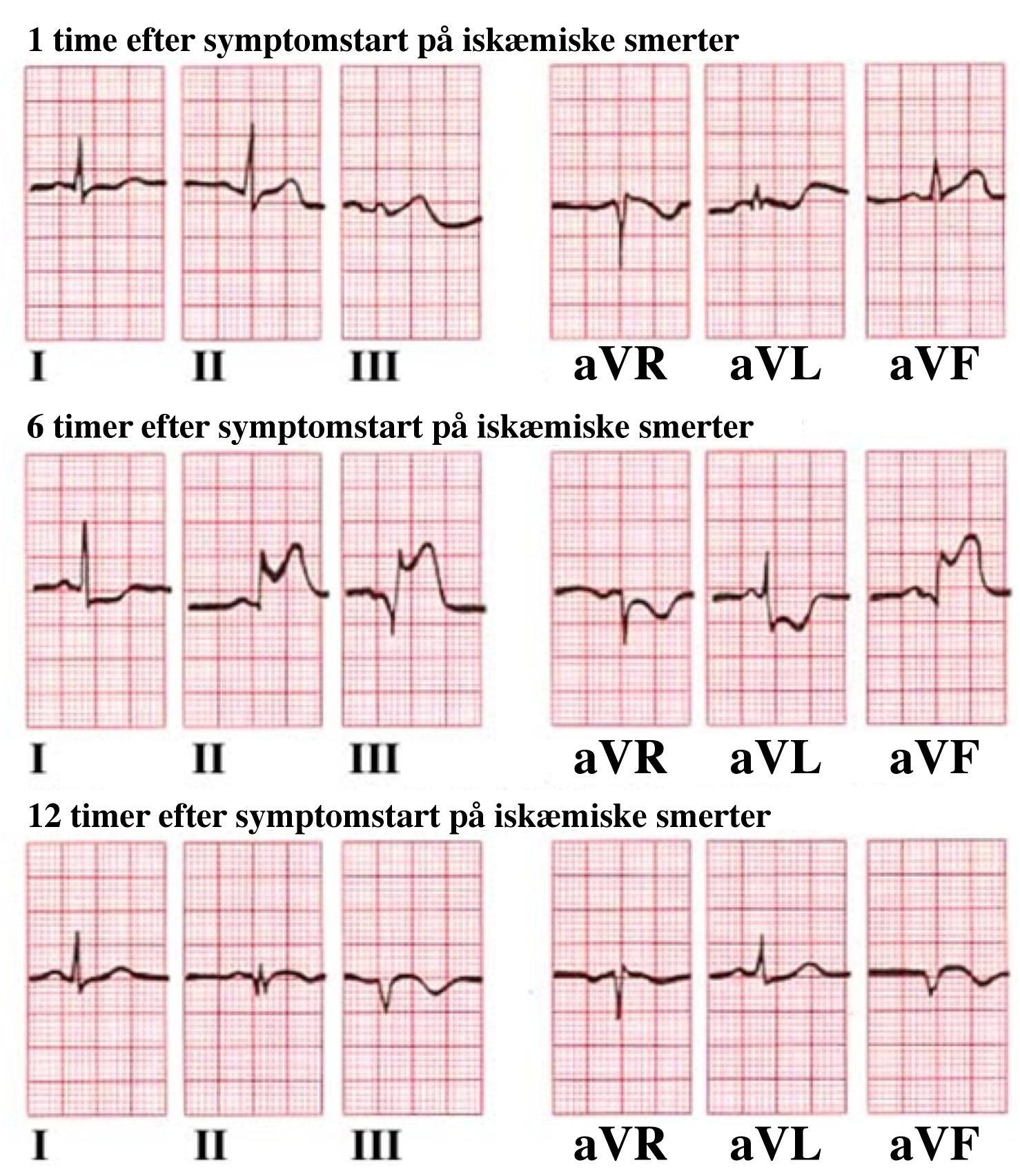 Infarkt, ekg-ændringer over tid - Patienthåndbogen på sundhed.dk