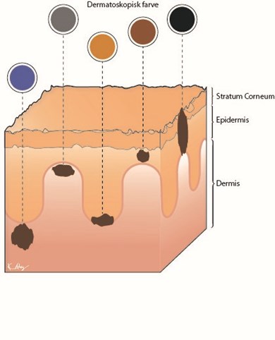 Dermatoskopi - Lægehåndbogen på sundhed.dk