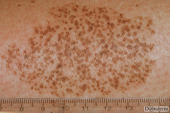 Nævus spilus/spilo-nævus - Patienthåndbogen på sundhed.dk