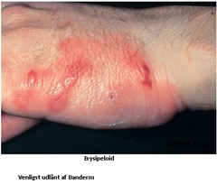 Erysipeloid, komplikationer ved - Lægehåndbogen på sundhed.dk