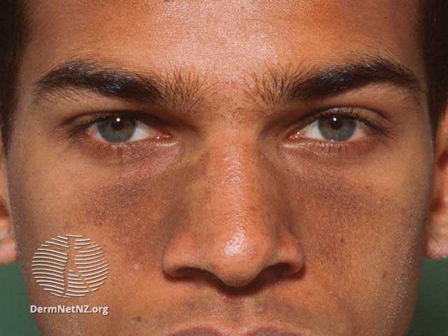 Seboroisk eksem, hyperpigmentering - Patienthåndbogen på sundhed.dk