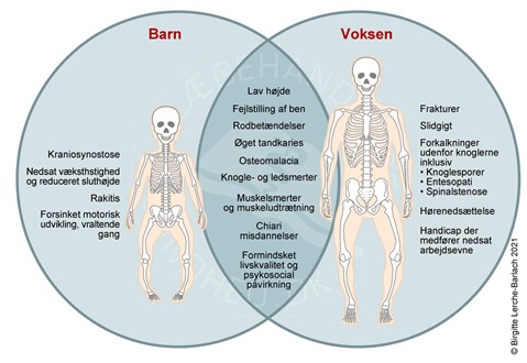 X-bunden hypofosfatæmisk rakitis - Lægehåndbogen på sundhed.dk