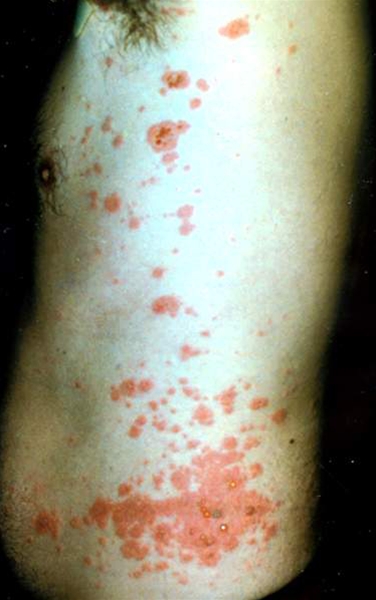 Pemfigoid - Lægehåndbogen på sundhed.dk