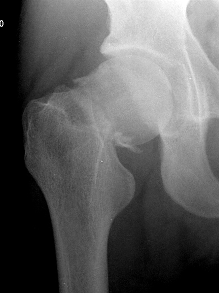 Collum femoris fraktur, forfra - Lægehåndbogen på sundhed.dk