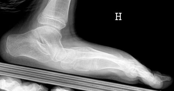 Platfod hos børn - Patienthåndbogen på sundhed.dk