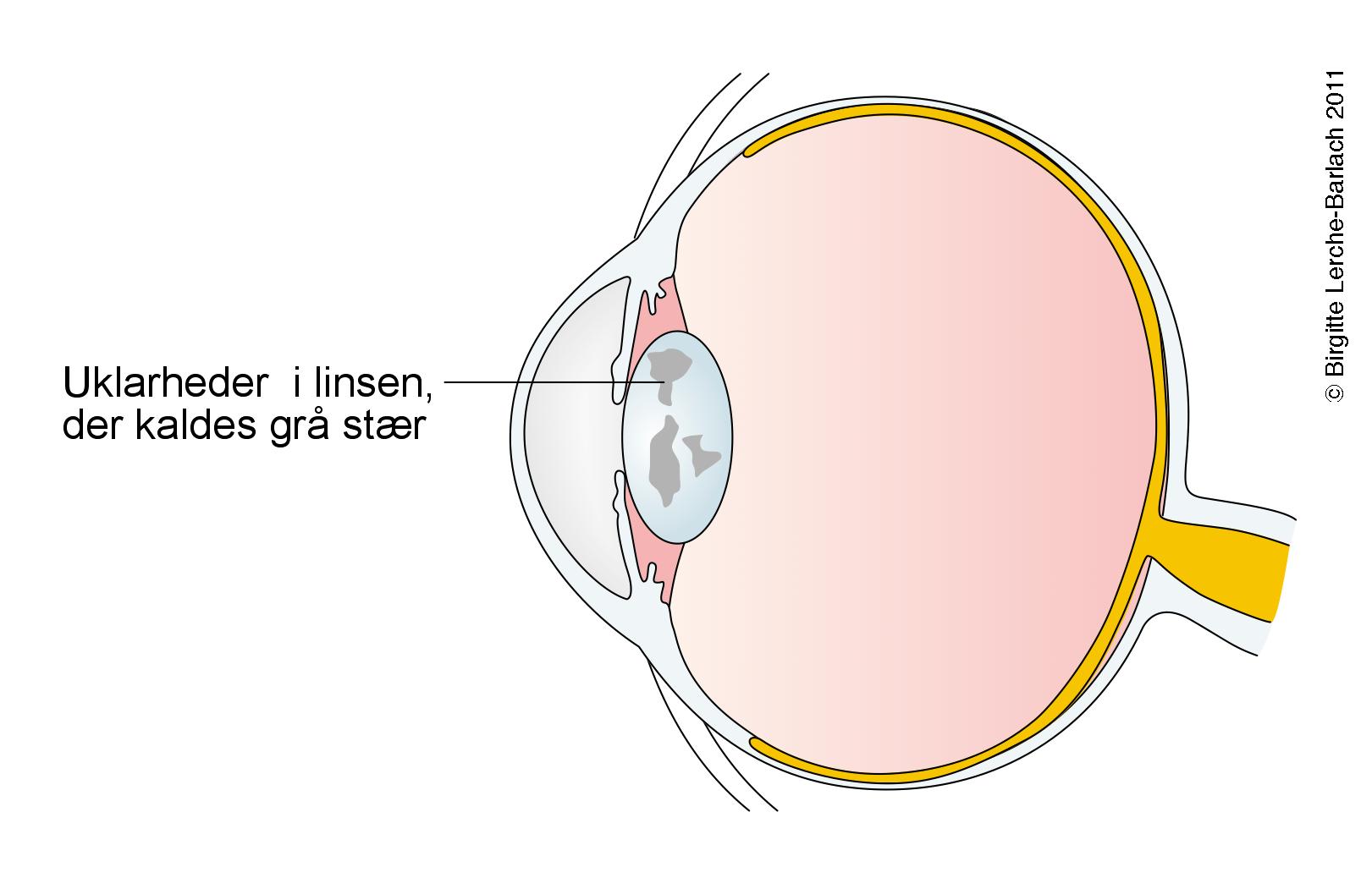 Grå stær (katarakt) - Patienthåndbogen på sundhed.dk