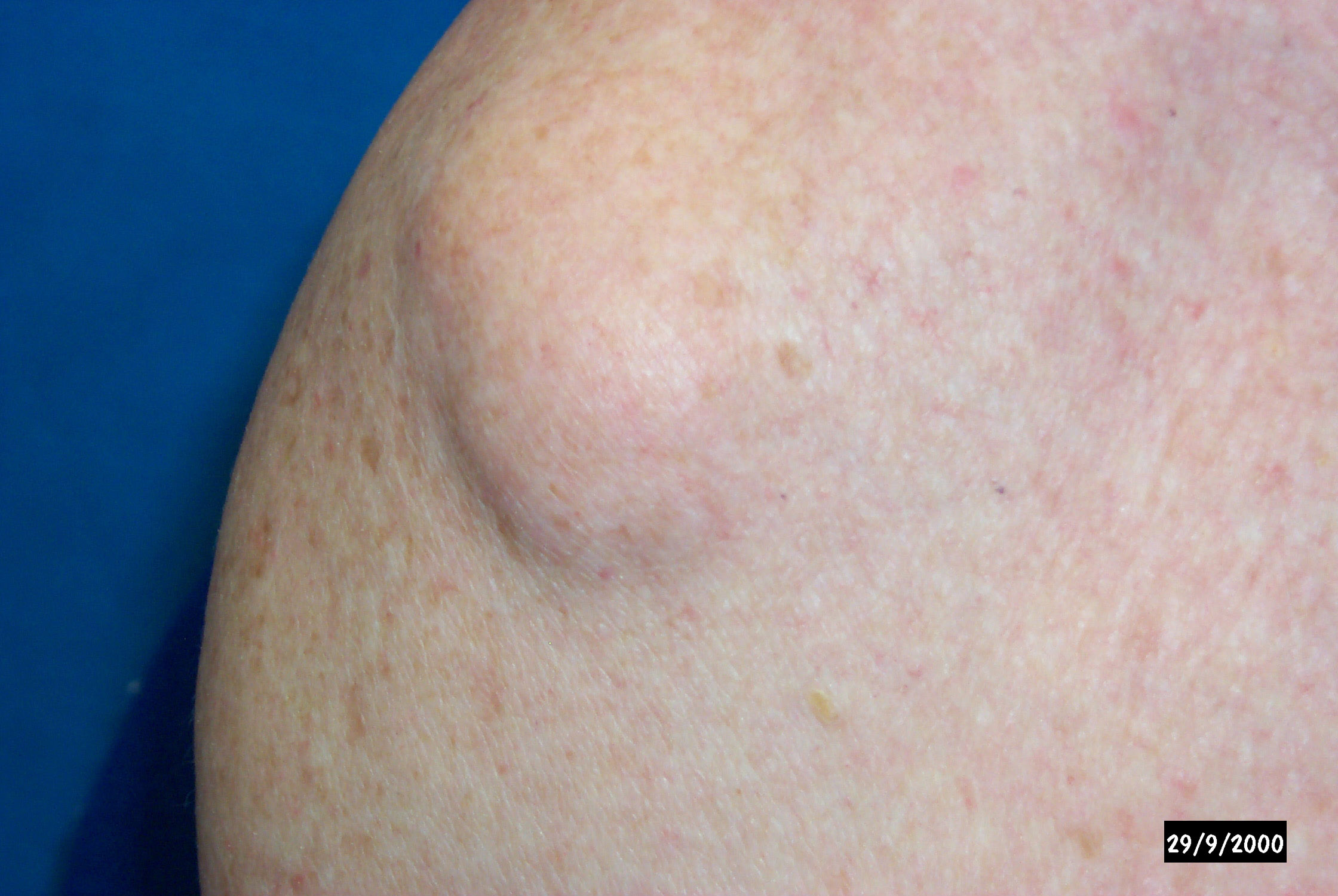 Lipom - Lægehåndbogen på sundhed.dk