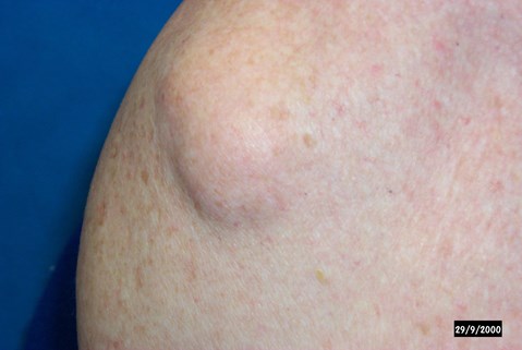 Lipom - Lægehåndbogen på sundhed.dk