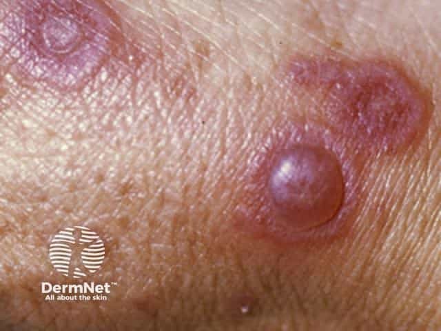 Erythema multiforme - Lægehåndbogen på sundhed.dk