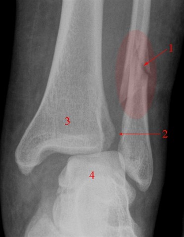 Røntgen af knoglerne - Patienthåndbogen på sundhed.dk