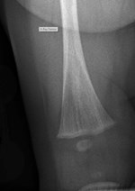 Osteopathia striata med craniel sclerosis - Lægehåndbogen på sundhed.dk