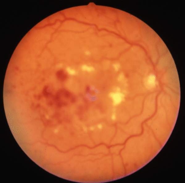 Diabetisk retinopati - Patienthåndbogen på sundhed.dk