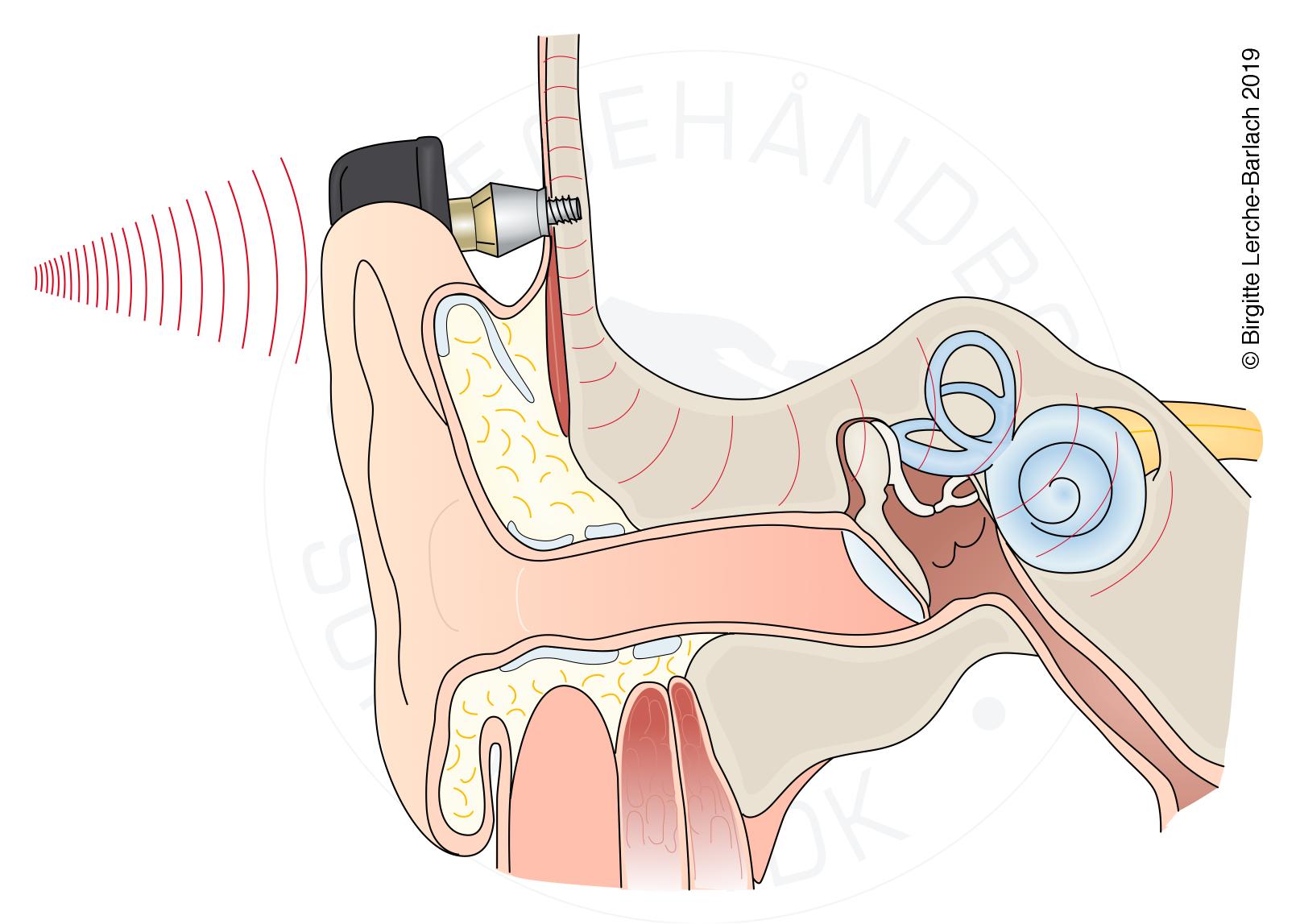 Knogleforankret høreapparat (BAHA) - Patienthåndbogen på sundhed.dk