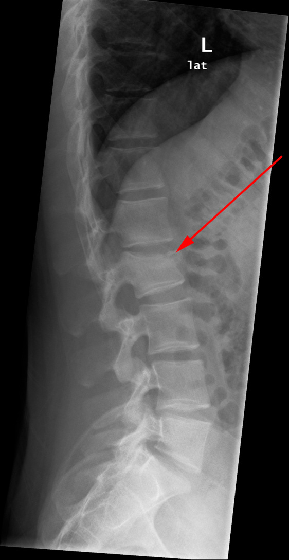 Columna lumbalis, kompressionsfraktur, røntgen - Lægehåndbogen på ...