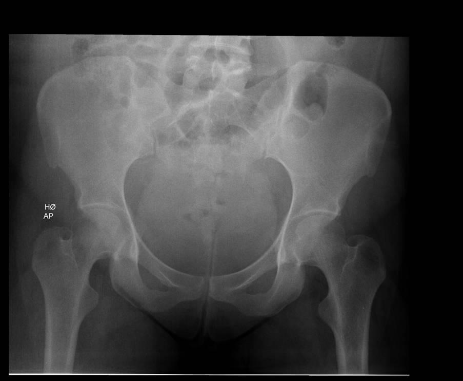 Bækken og hofterne, normal, røntgen - Lægehåndbogen på sundhed.dk