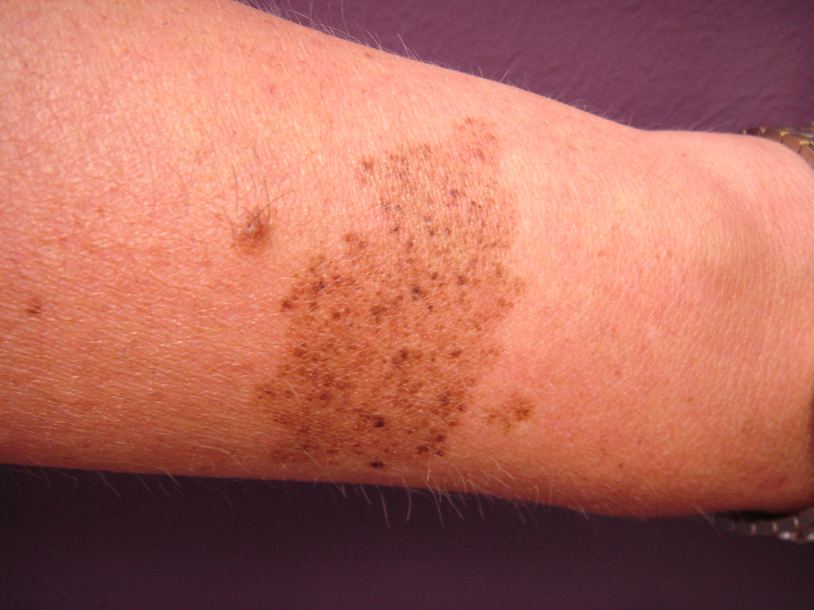 Nævi og andre pigmenterede hudforandringer - Lægehåndbogen på sundhed.dk