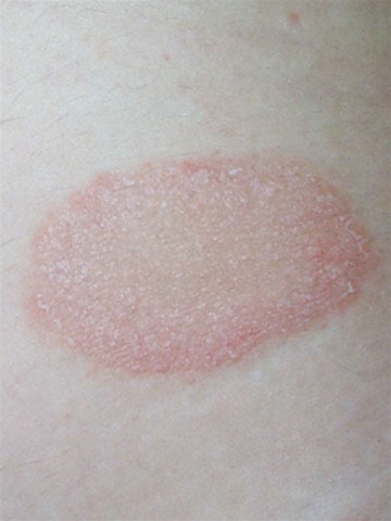 Pityriasis rosea - Patienthåndbogen på sundhed.dk