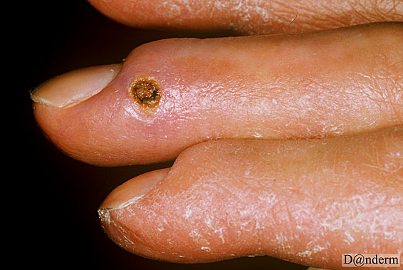 Systemisk sklerodermi - Lægehåndbogen på sundhed.dk