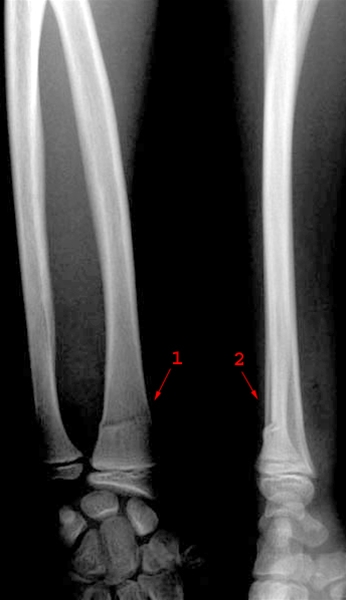 Fraktur distalt i radius - Lægehåndbogen på sundhed.dk