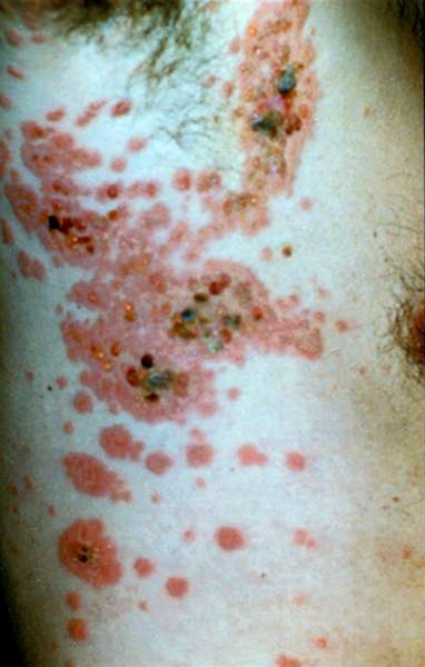 Pemfigoid - Lægehåndbogen på sundhed.dk