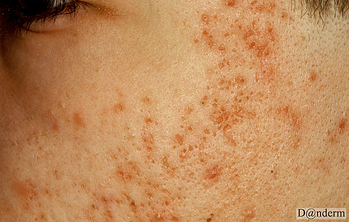 Akne, ar - Patienthåndbogen på sundhed.dk