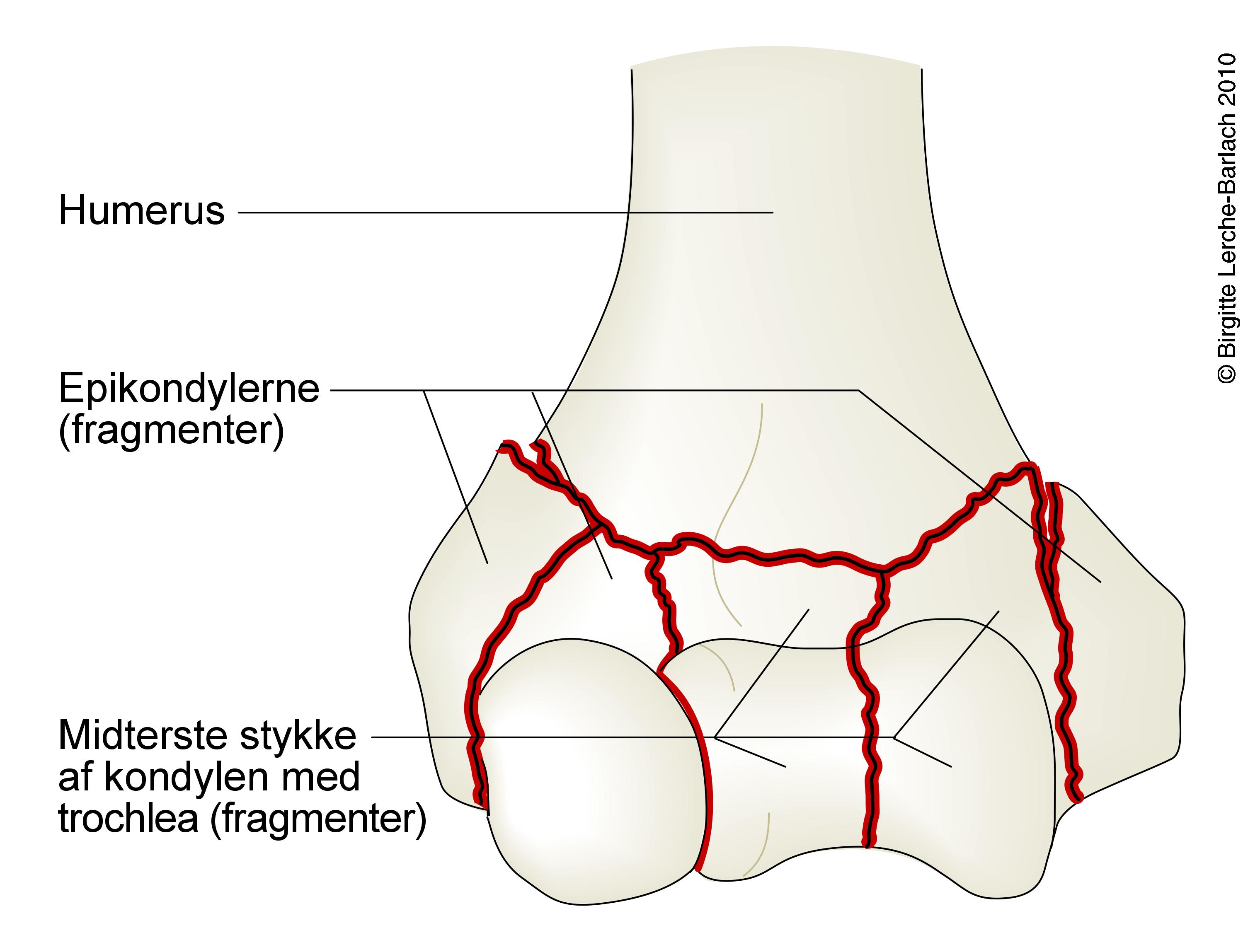 Humerus, Komminut distal humerus fraktur - Patienthåndbogen på sundhed.dk