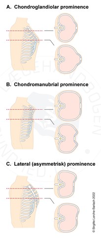 Fuglebryst - Lægehåndbogen på sundhed.dk