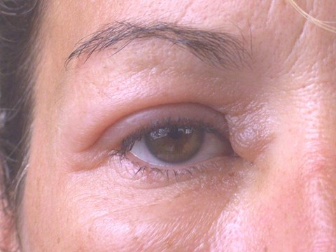 Urticaria og angioødem - Lægehåndbogen på sundhed.dk