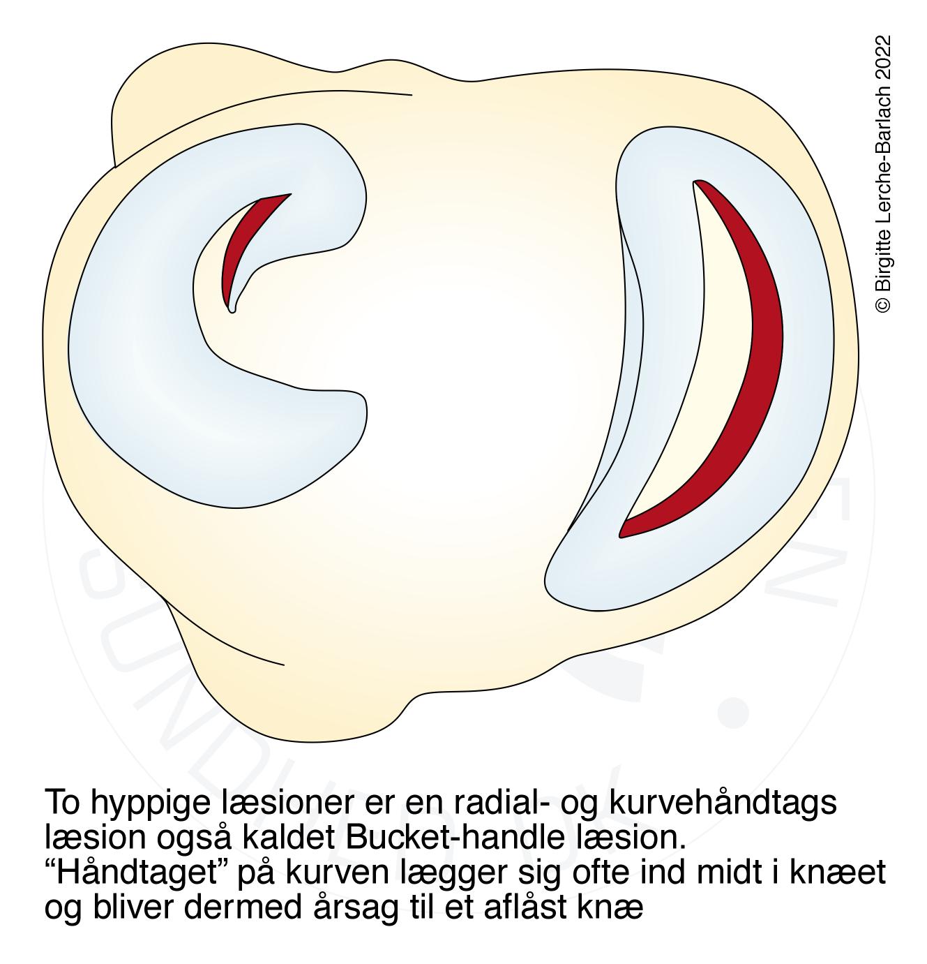 Radial læsion og bucket handle læsion af menisk - Patienthåndbogen på ...