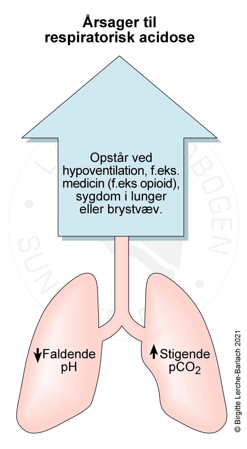 Patienthåndbogen - Respiratorisk acidose - sundhed.dk