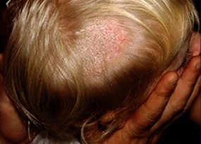 Hårbunds svamp - Patienthåndbogen på sundhed.dk