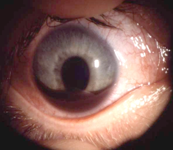 Hyphæma - Lægehåndbogen på sundhed.dk