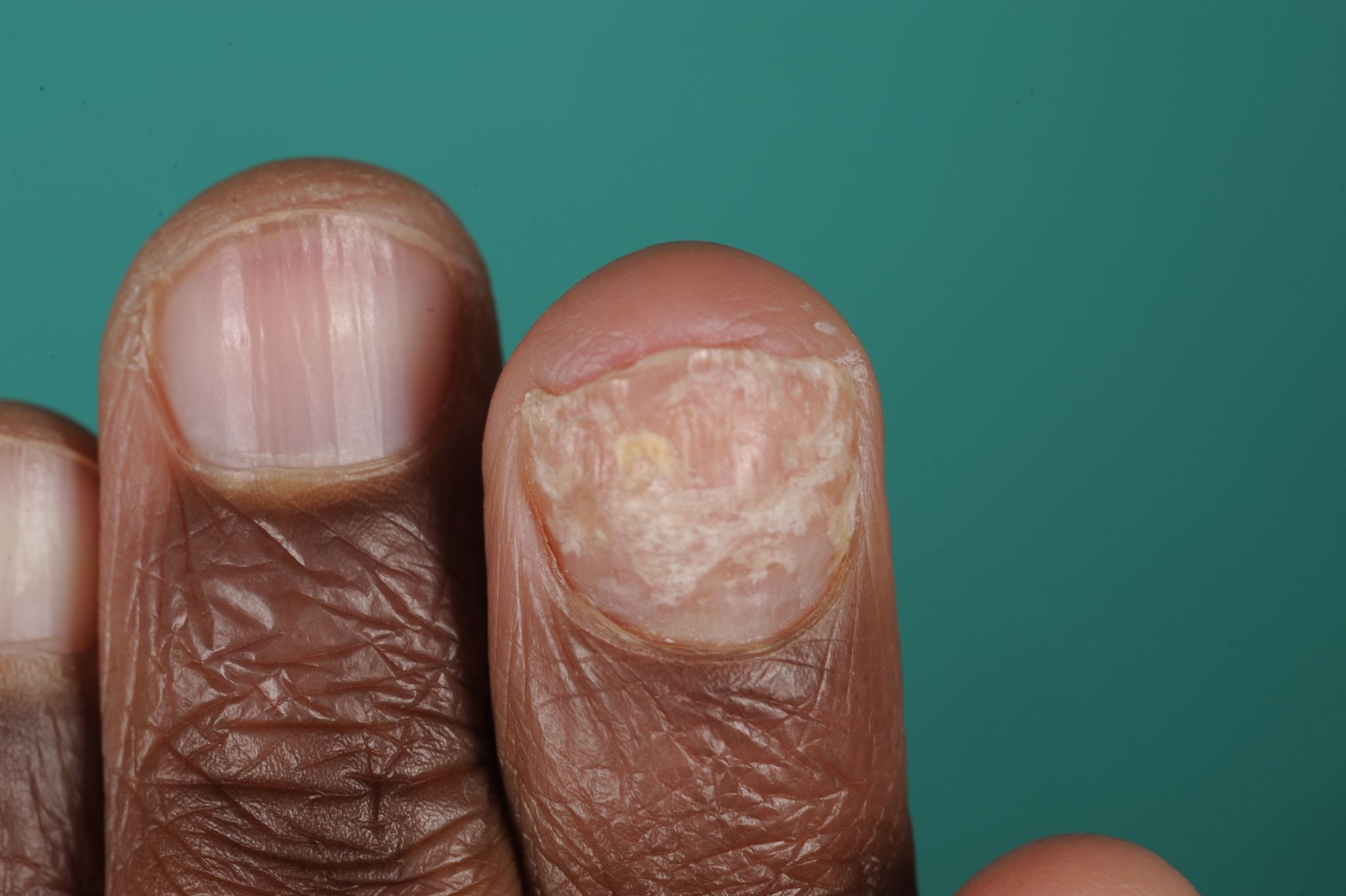 Svampeinfektioner - Patienthåndbogen på sundhed.dk