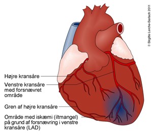 Angina pectoris, årsager - Patienthåndbogen på sundhed.dk