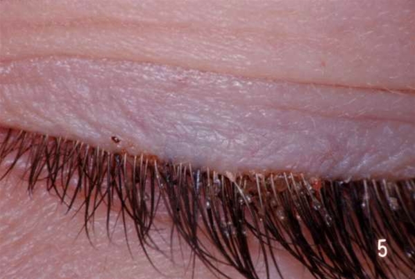 Fladlus i øjenvipper - Patienthåndbogen på sundhed.dk