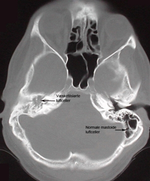 Mastoiditis acuta - Lægehåndbogen på sundhed.dk