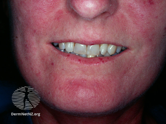 Systemisk sklerodermi - Lægehåndbogen på sundhed.dk