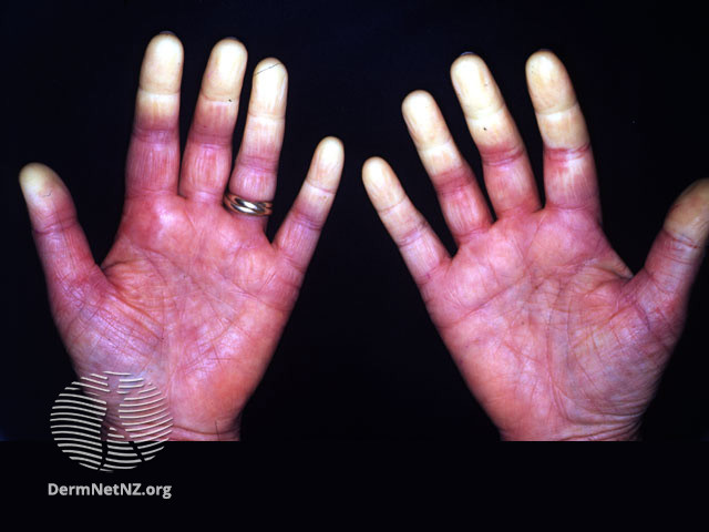 Systemisk sklerodermi - Patienthåndbogen på sundhed.dk